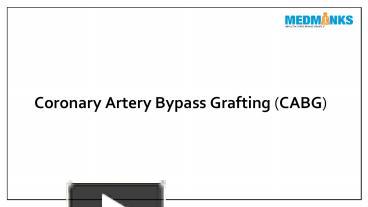 Coronary Artery Bypass Grafting (CABG) (1) presentation | free to download