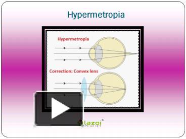 Hypermetropia: Causes, Symptoms, Daignosis, Prevention and Treatment ...