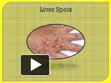 PPT – Liver Spots : Causes, Symptoms, Daignosis, Prevention and ...