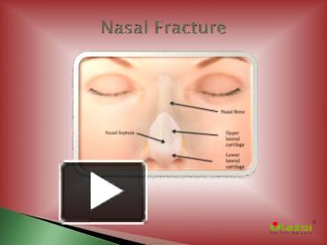 PPT – Nasal Fracture : Broken Nose Symptoms, Signs, Surgery & Treatment ...