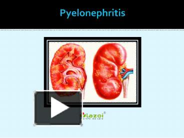 Pyelonephritis: Causes, Symptoms, Daignosis, Prevention and Treatment ...