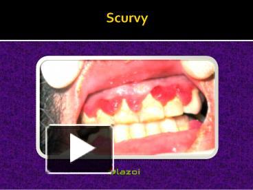 Scurvy: Causes, Symptoms, Daignosis, Prevention and Treatment ...