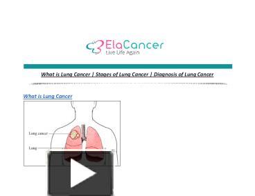 PPT – What is Lung Cancer | Stages of Lung Cancer | Diagnosis of Lung ...