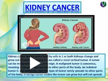 PPT – Types of kidney cancer and its cells by Thecureforcancer ...