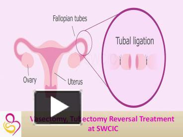 Vasectomy Tubectomy Reversal Treatment presentation | free to download