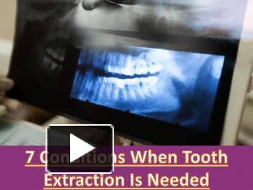 PPT – 7 Conditions When Tooth Extraction Is Needed PowerPoint ...