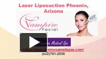 PPT – Laser Liposuction Phoenix, Arizona PowerPoint presentation | free ...