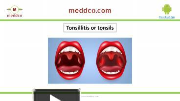 Tonsillitis types,Causes,Symptoms,Diagnosis,Prevention and treatment ...
