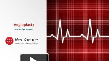 PPT – Angioplasty In India PowerPoint presentation | free to download ...