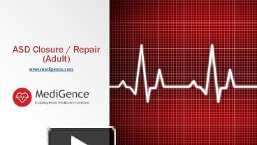 PPT – ASD Closure Repair Adult PowerPoint presentation | free to ...
