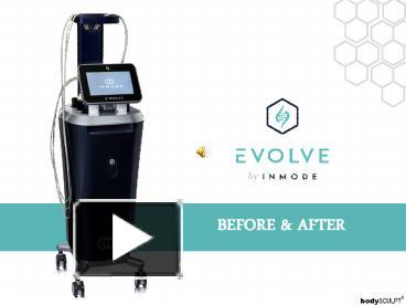 EVOLVE by InMode – Before & After presentation | free to download