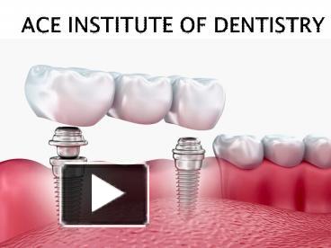 PPT – Rotary Endodontics Course And Dental Implant Courses in India ...