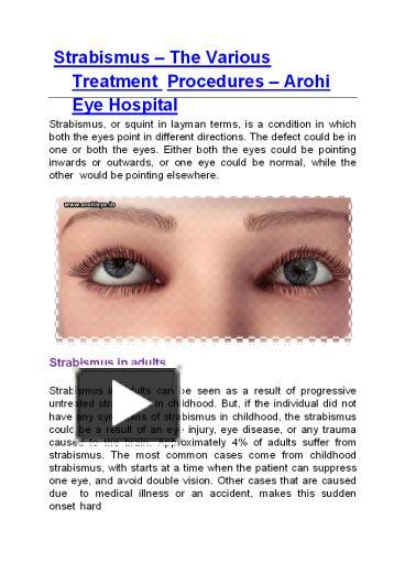 PPT – Strabismus – The Various Treatment Procedures - Arohi Eye ...