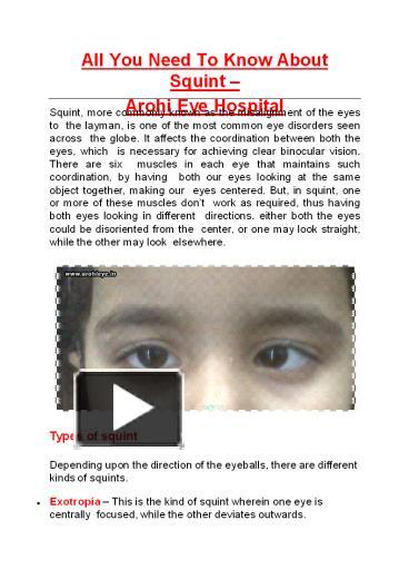 PPT – All You Need To Know About Squint - Arohi Eye Hospital PowerPoint ...