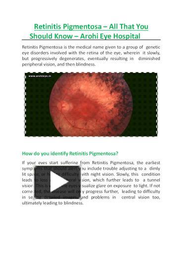 PPT – Retinitis Pigmentosa – All That You Should Know - Arohi Eye ...