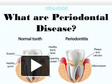 PPT – What are Periodontal Disease? PowerPoint presentation | free to ...