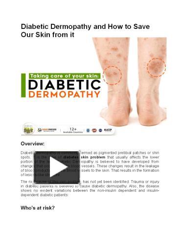 Shin Spots Pigmented Pretibial Patches quintwakes