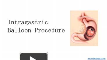 Intragastric Balloon presentation | free to download