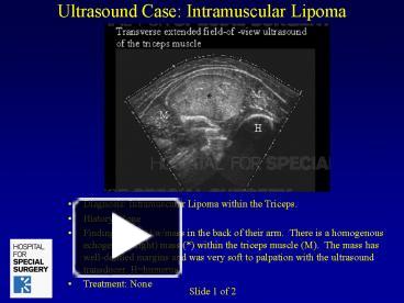 Ultrasound Case: Intramuscular Lipoma presentation | free to view
