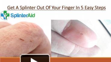 PPT – Get A Splinter Out Of Your Finger In Easy 5 Steps PowerPoint ...