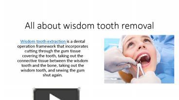 wisdom tooth extraction presentation | free to download