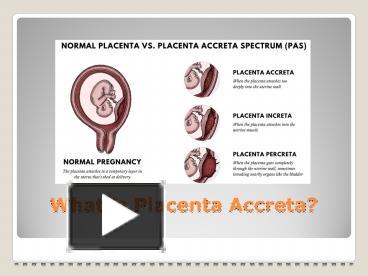 What is Placenta Accreta? | Specialty Care Clinics presentation | free ...