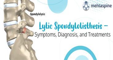 Lytic Spondylolisthesis Treatment and Diagnosis | Mehta Spine ...