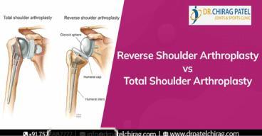 Reverse Shoulder Arthroplasty vs Total Shoulder Arthroplasty | Dr ...