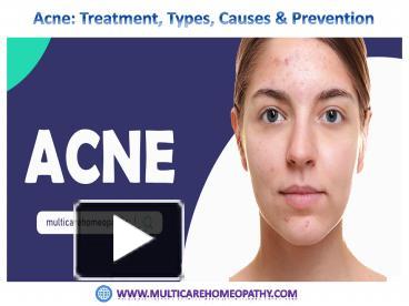 Acne: Treatment, Types, Causes & Prevention presentation | free to download