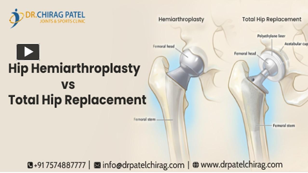 Hip Hemiarthroplasty vs Total Hip Replacement Indications presentation ...