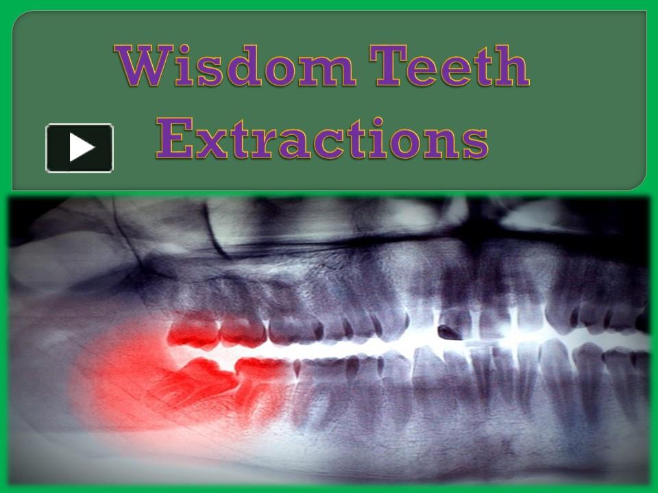 Wisdom Teeth Extractions presentation | free to download