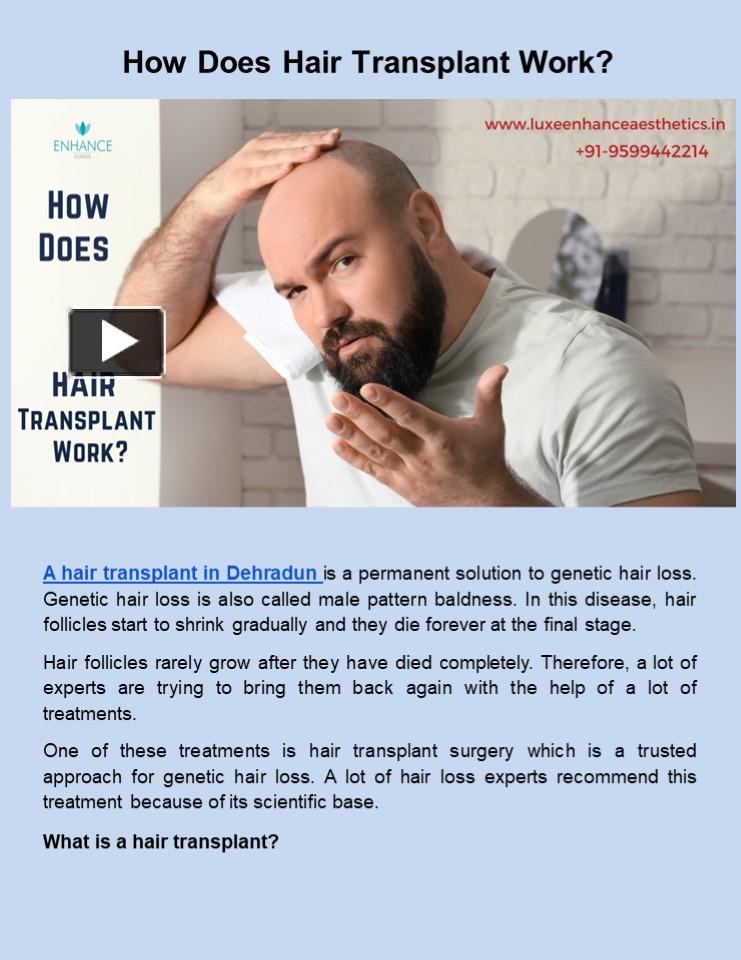 PPT – How Does Hair Transplant Work? PowerPoint presentation | free to ...