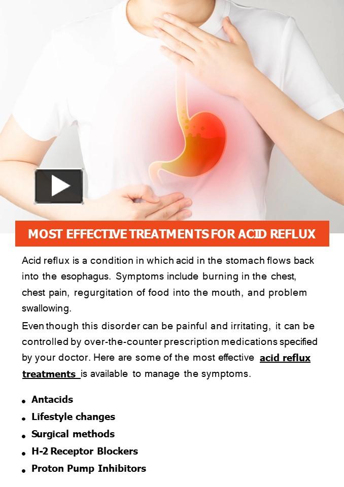 MOST EFFECTIVE TREATMENTS FOR ACID REFLUX presentation | free to download