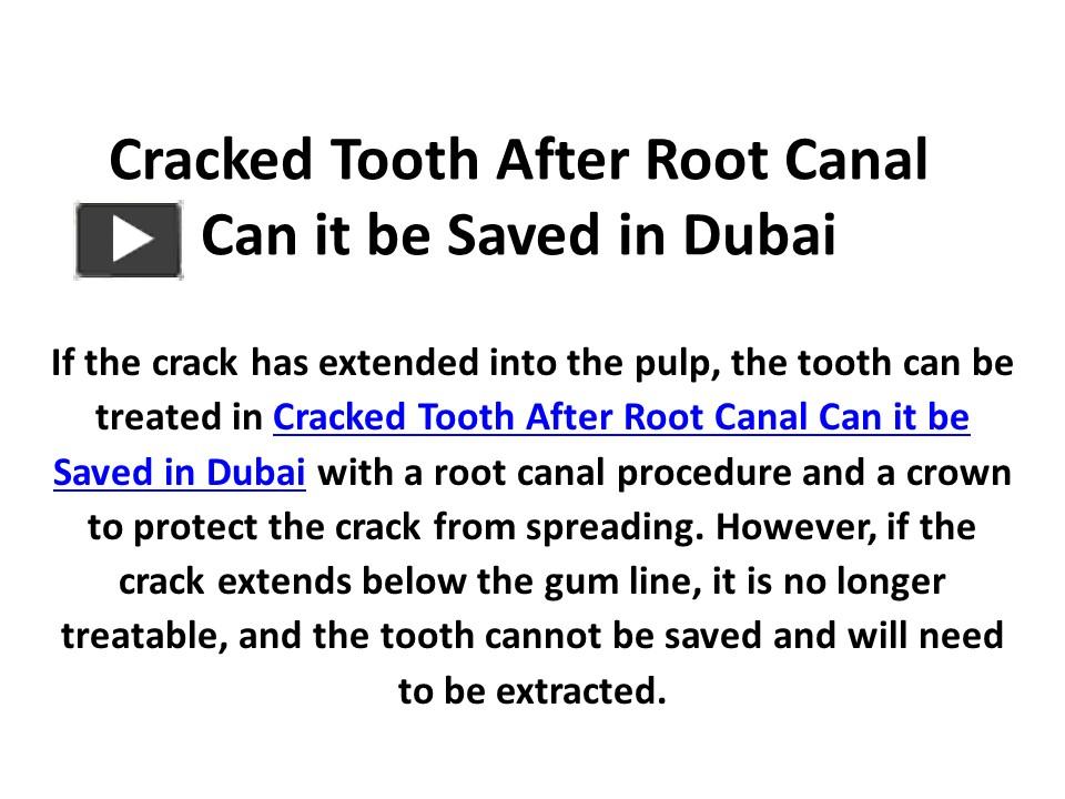 PPT – Cracked Tooth After Root Canal Can it be Saved in Dubai ...