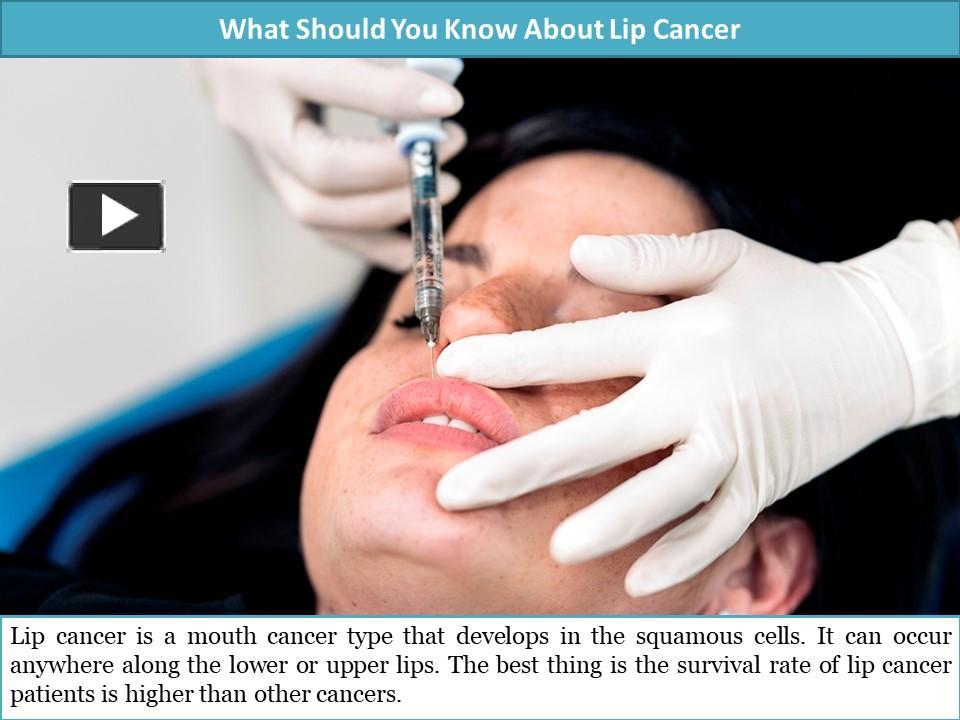 PPT – What Should You Know About Lip Cancer PowerPoint presentation ...