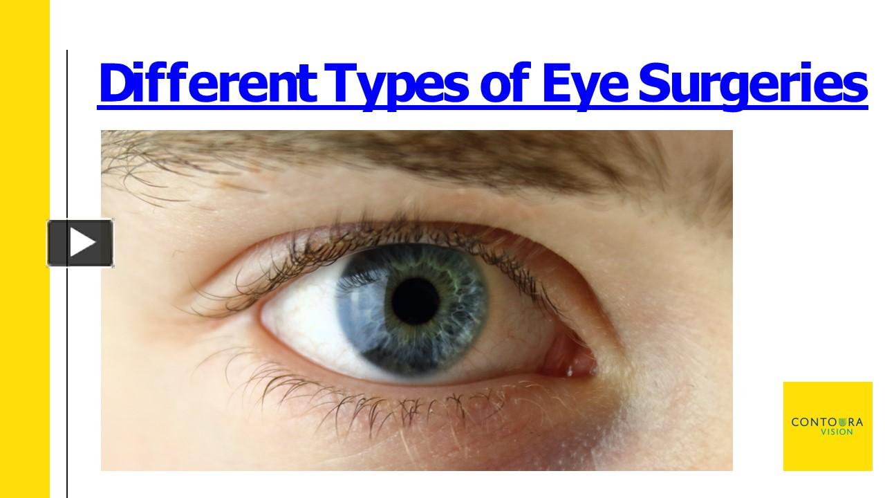 Different Types of Eye Surgeries presentation | free to download