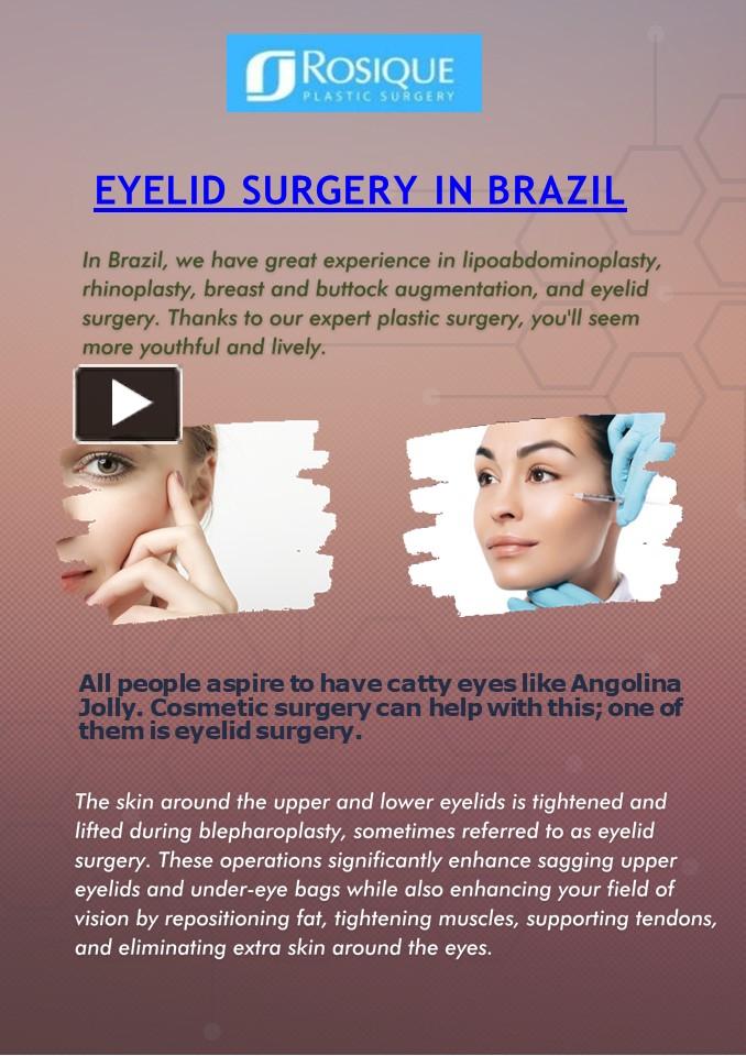 PPT – Best Eyelid Surgery in Brazil | Rosique Plastic Surgery ...