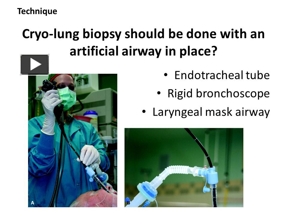Cryo-lung biopsy should be done with an artificial airway in place - Dr ...