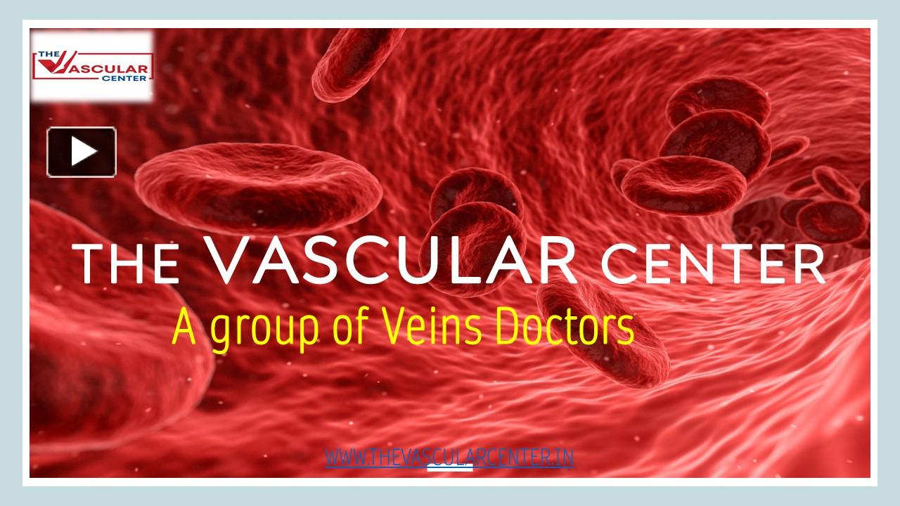 PPT – The Vascular Center Expert Care for Vein Disorders PowerPoint ...