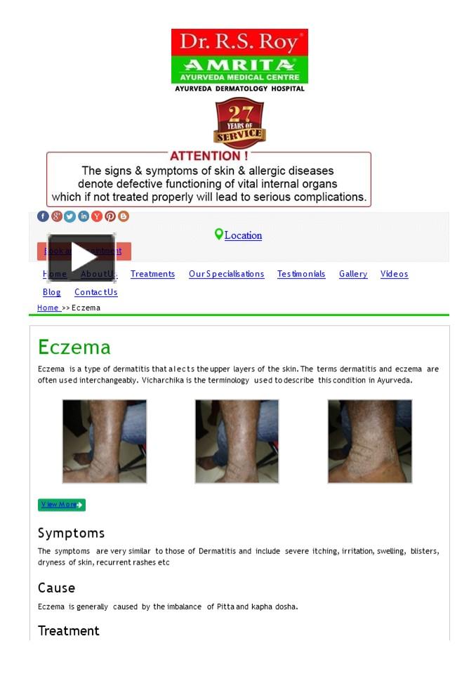 PPT – Best Ayurvedic Dermatologist Treating Eczema | Dr.RS.ROY | Amrita ...
