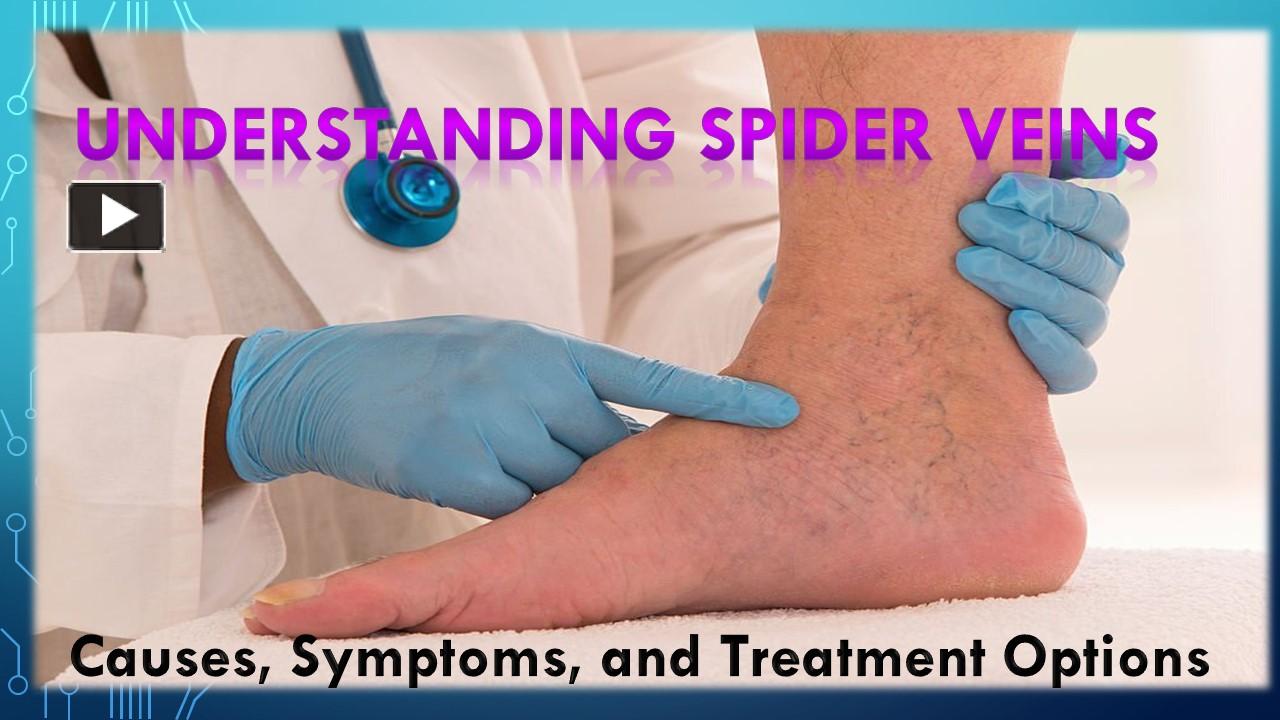Understanding Spider Veins Causes Symptoms and Treatment Options ...
