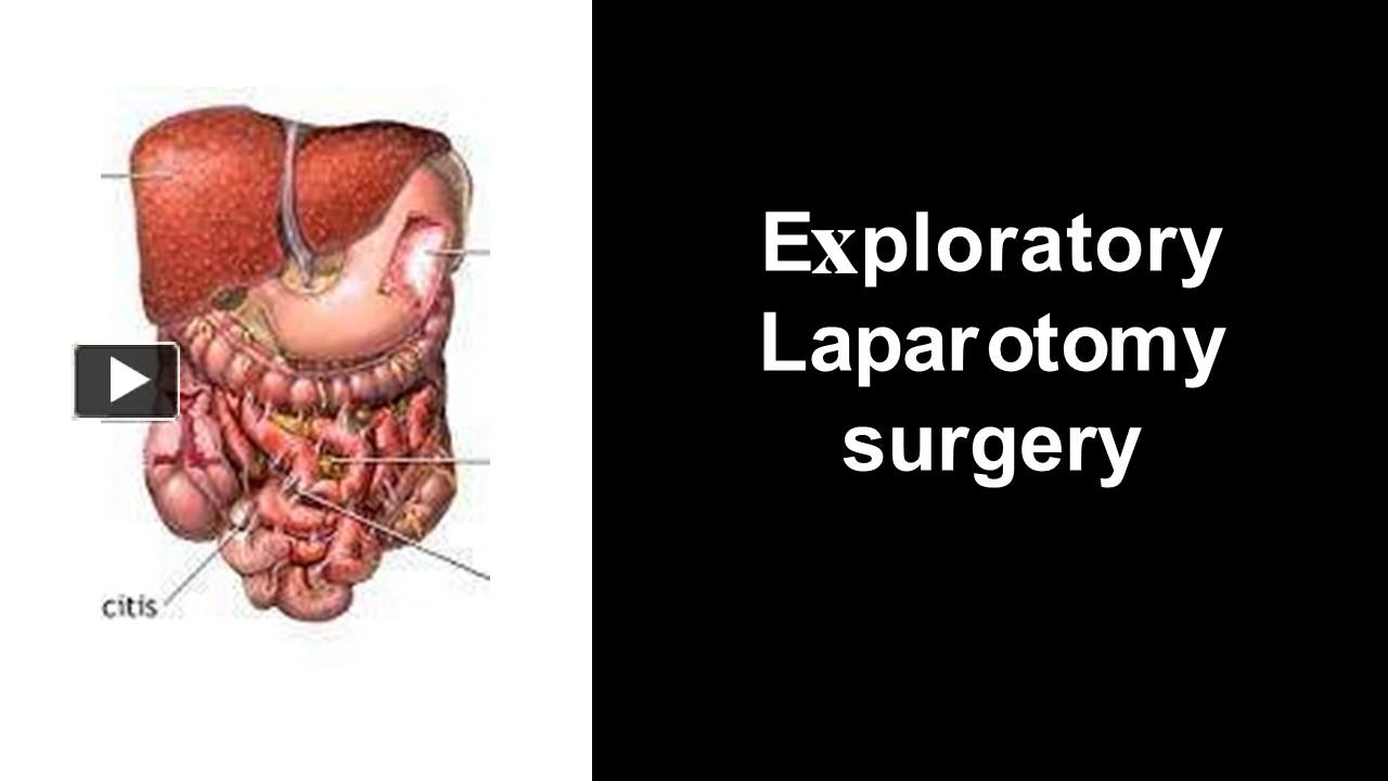 Exploratory Laparotomy surgery presentation | free to download