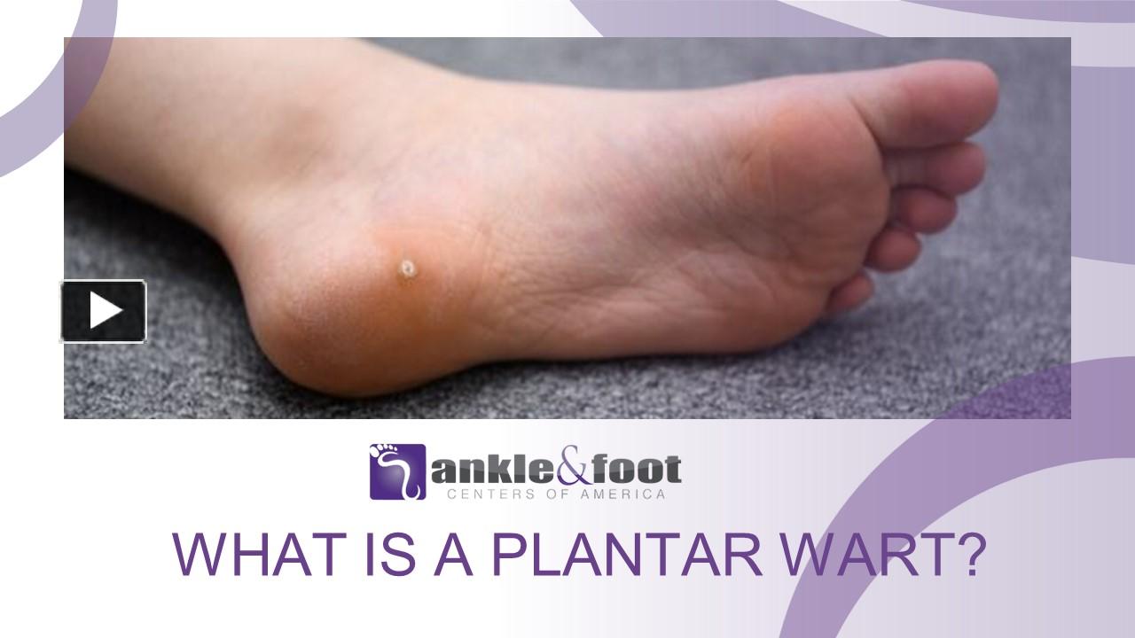 What is a Plantar Wart? presentation | free to download