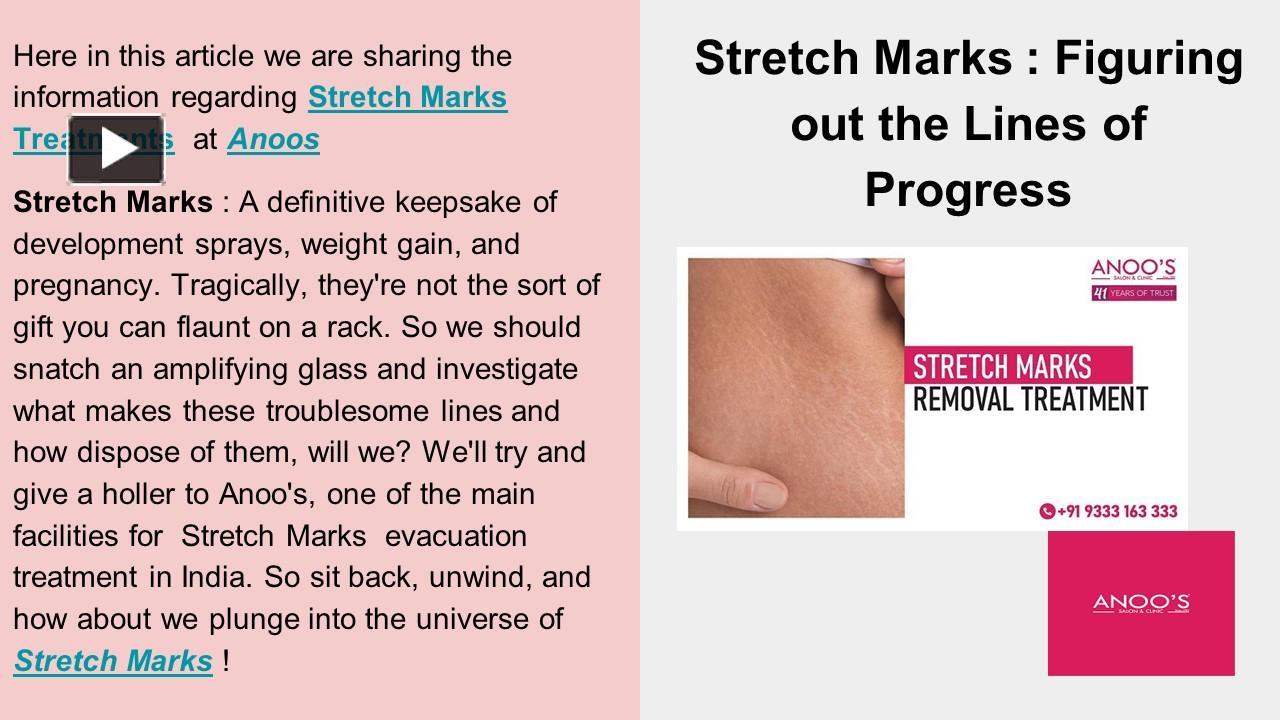 PPT – Stretch Marks Treatments PowerPoint presentation | free to ...