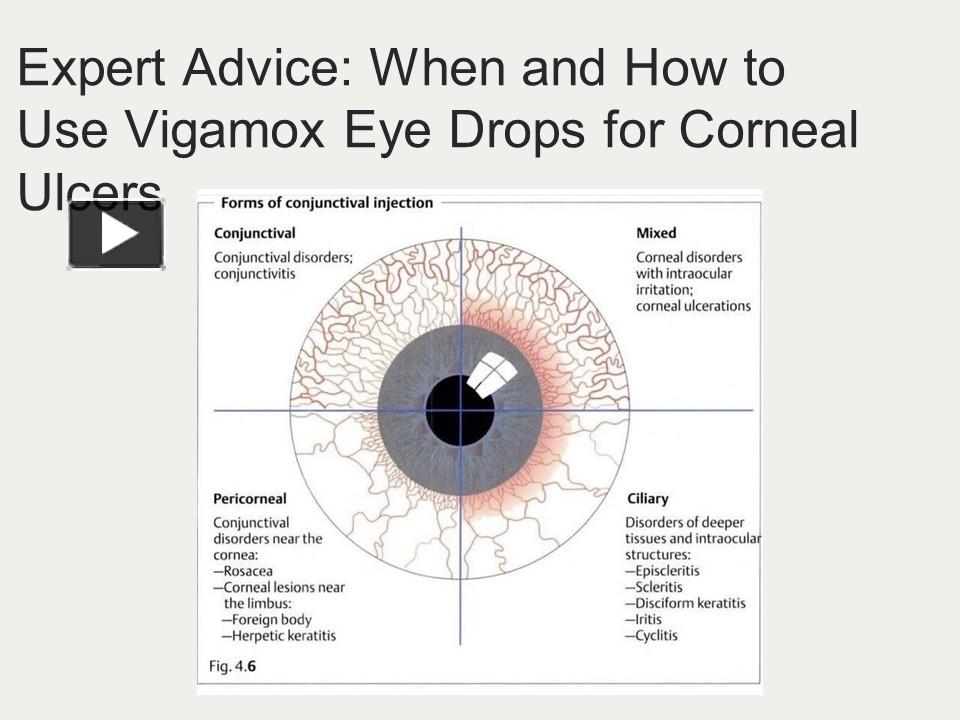 Expert Advice: When and How to Use Vigamox Eye Drops for Corneal Ulcers ...