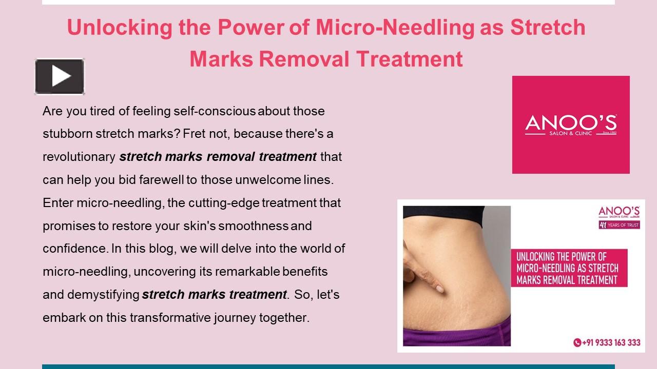 Unlocking the Power of Micro-Needling as Stretch Marks Removal ...