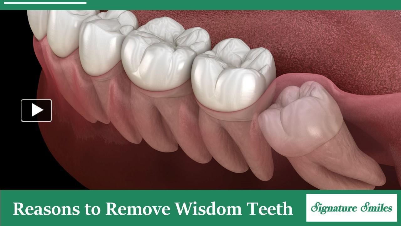 PPT – 4 Reasons to Get Your Wisdom Teeth Removed Right Away! PowerPoint ...