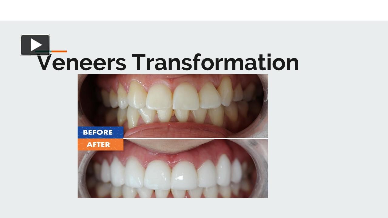 PPT – Veneers Transformation PowerPoint presentation | free to download ...