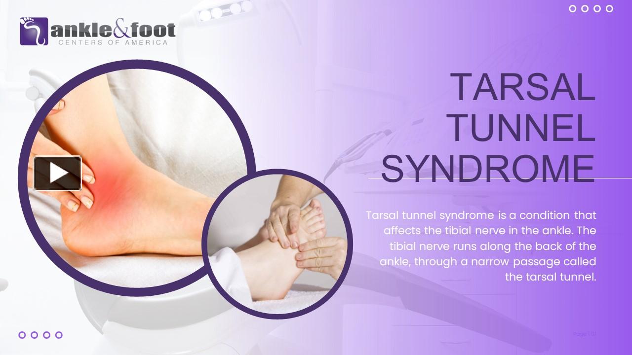 Tarsal Tunnel Syndrome Treatment presentation | free to download