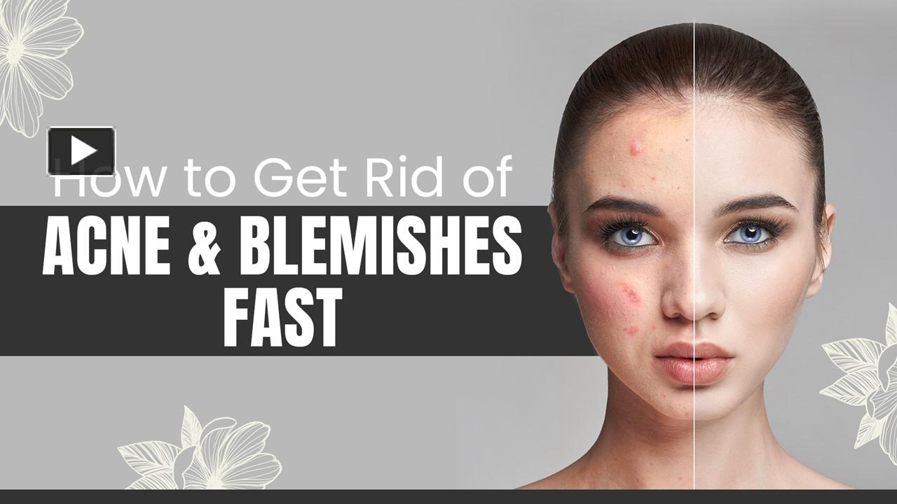 How to Get Rid of Acne and Blemishes Fast presentation | free to download